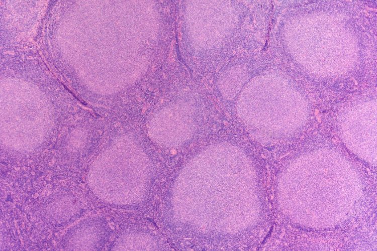 FDA expands approval of Adcetris for classical Hodgkin lymphoma