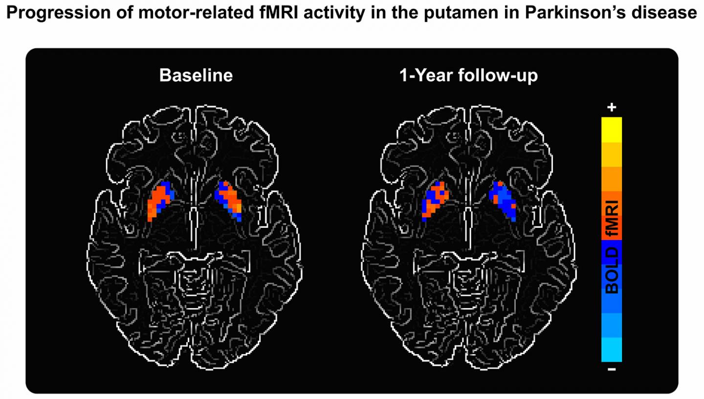 Biomarker breakthrough could improve Parkinson's treatment